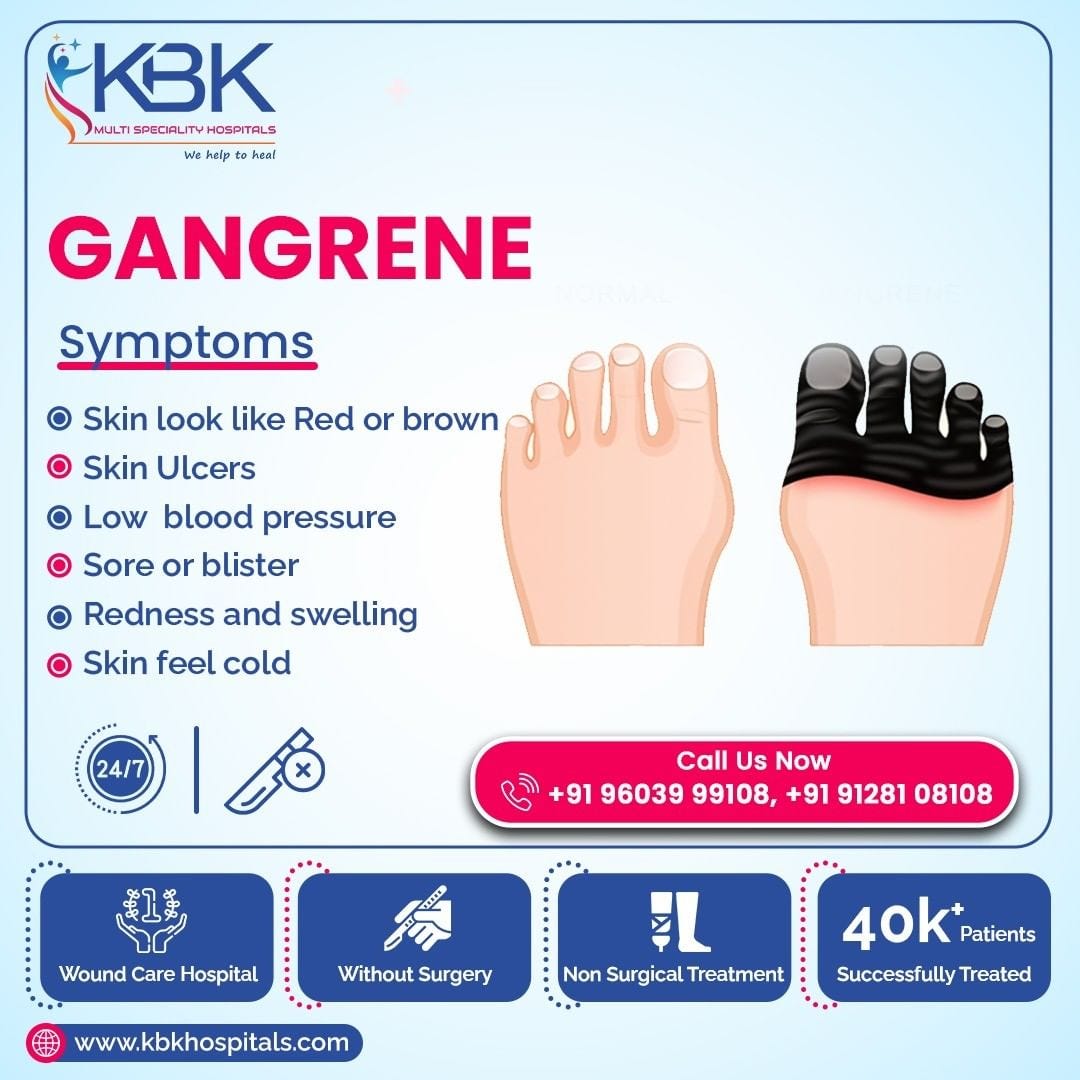 Gangrene: Symptoms and Treatment | KBK Multispeciality Hospitals - KBK ...
