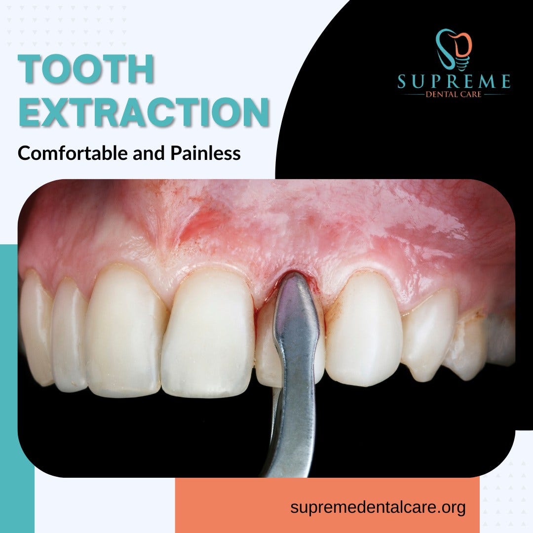 Safe & Pain-less Tooth Extractions in Orland Park, IL | by Supreme ...