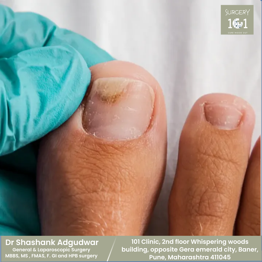 What are the symptoms of onycholysis? | by The 101 Clinic | Sep, 2024 ...