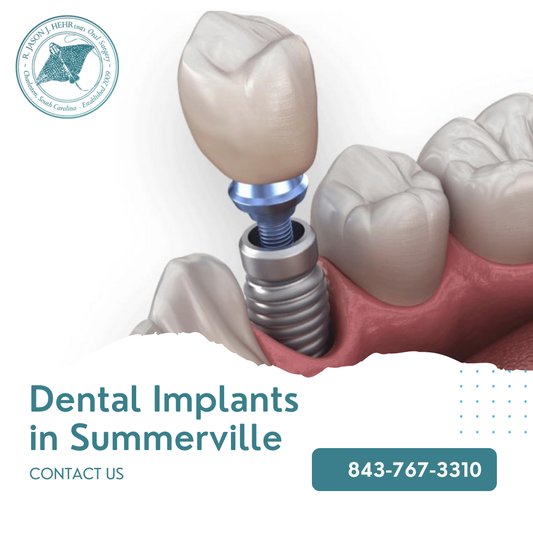 Dental Implants in Summerville | Hehr Oral Surgery - Hehr Oral ...