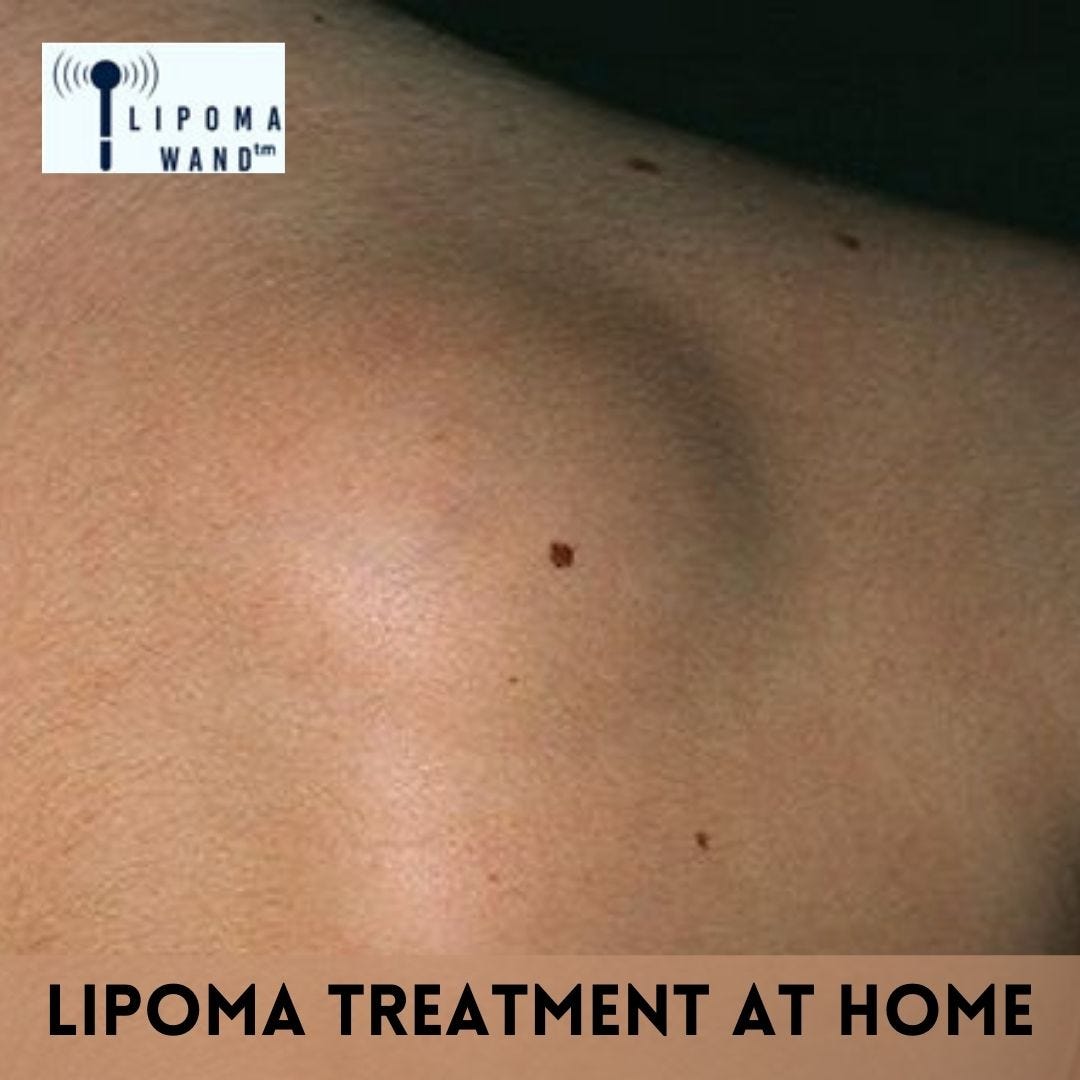 Understand the lipoma & What Possible Lipoma Treatments are Available ...
