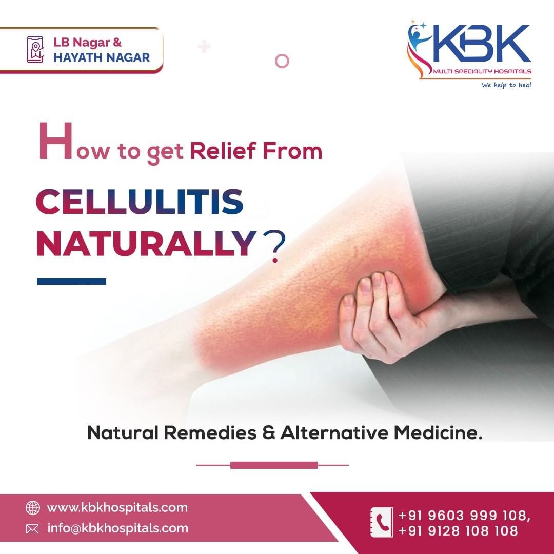 Cellulitis treatment: quick relief | KBK Hospitals - KBK Hospitals - Medium