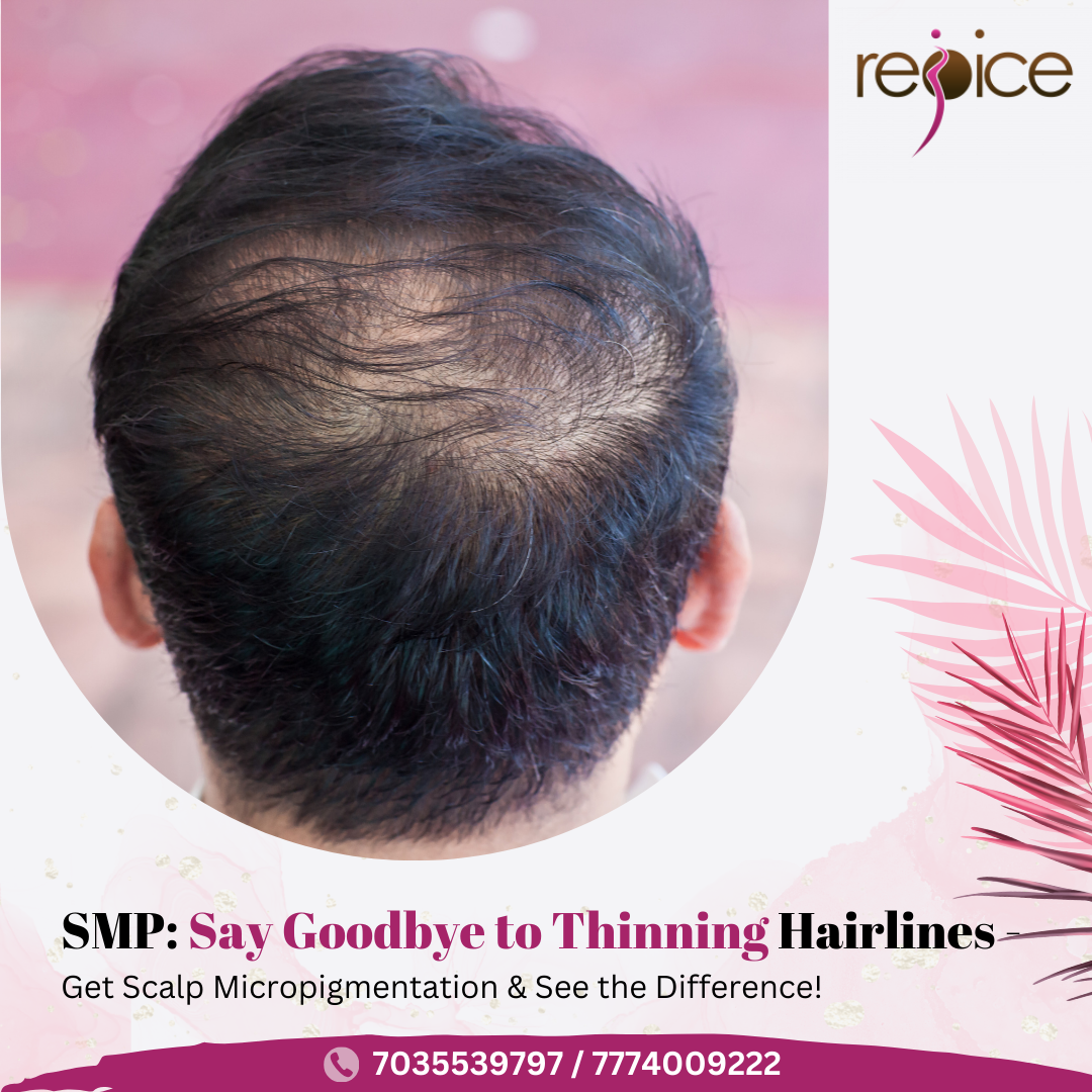 Say Goodbye to Thinning Hairlines with SMP! Best Hair Transplant in ...