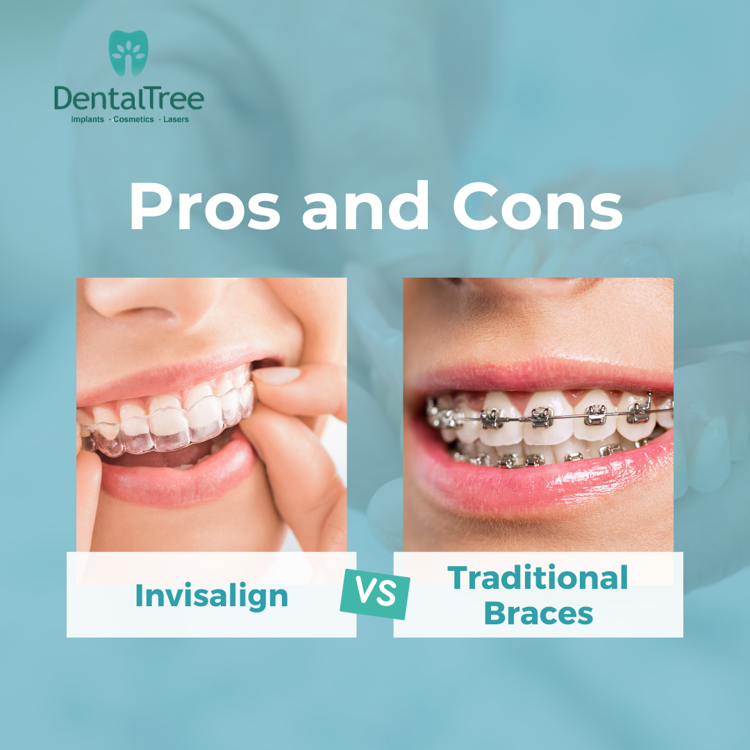 Invisalign vs. Traditional Braces: Pros and Cons | Best Dentist in Aundh Pune. | by ...