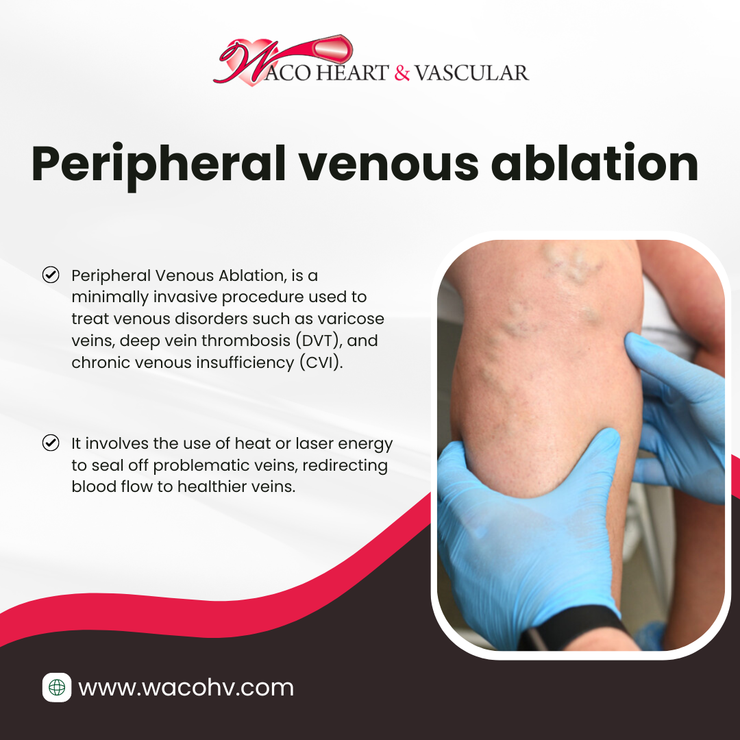 Enhancing Health with Peripheral Venous Ablation in Waco, TX | by Vani ...