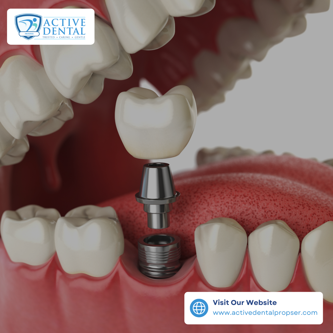 Transform Your Smile with Dental Implants in Prosper | by Active Dental ...