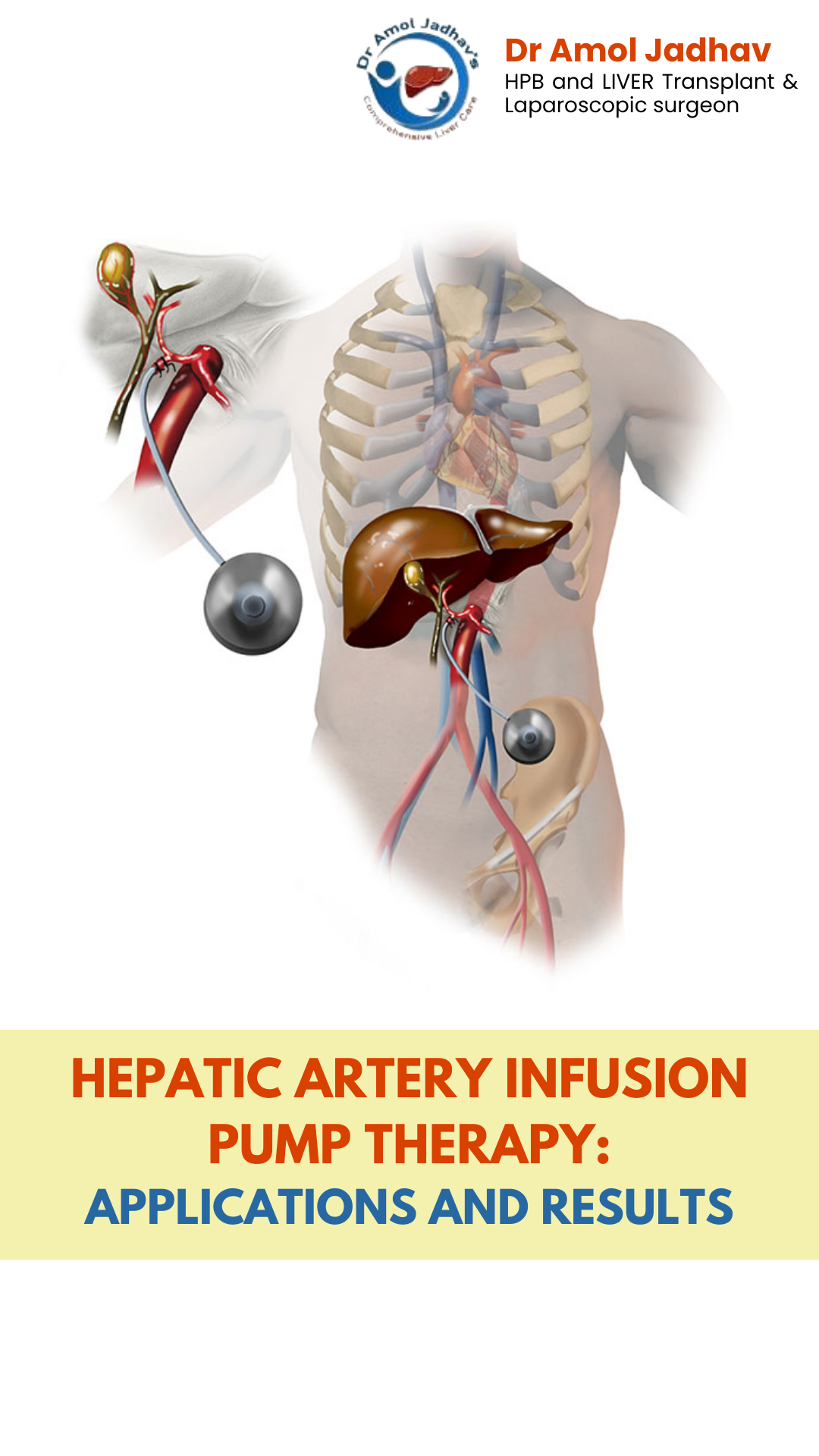 Hepatic Artery Infusion Pump Therapy | Dr. Amol Jadhav | Best Liver ...