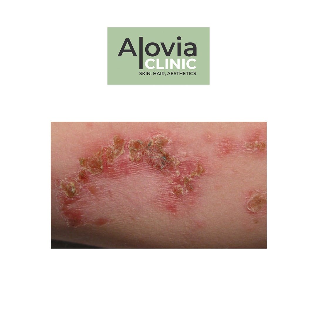 Fungal Infections Of The Skin. With the summertime weather… | by Alovia ...