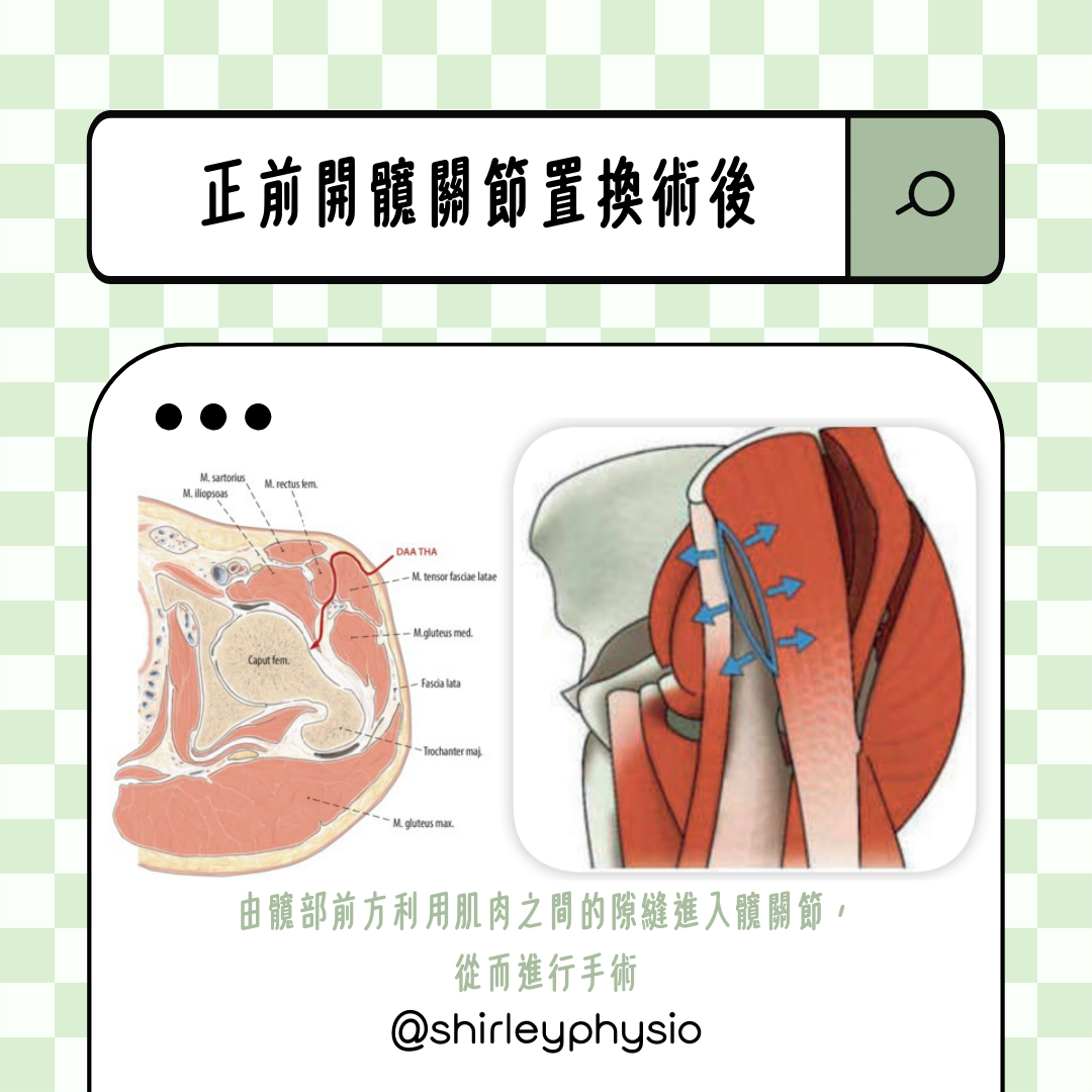 正前開髖關節置換 - Shirley Physio 賴冠帆物理治療師 - Medium
