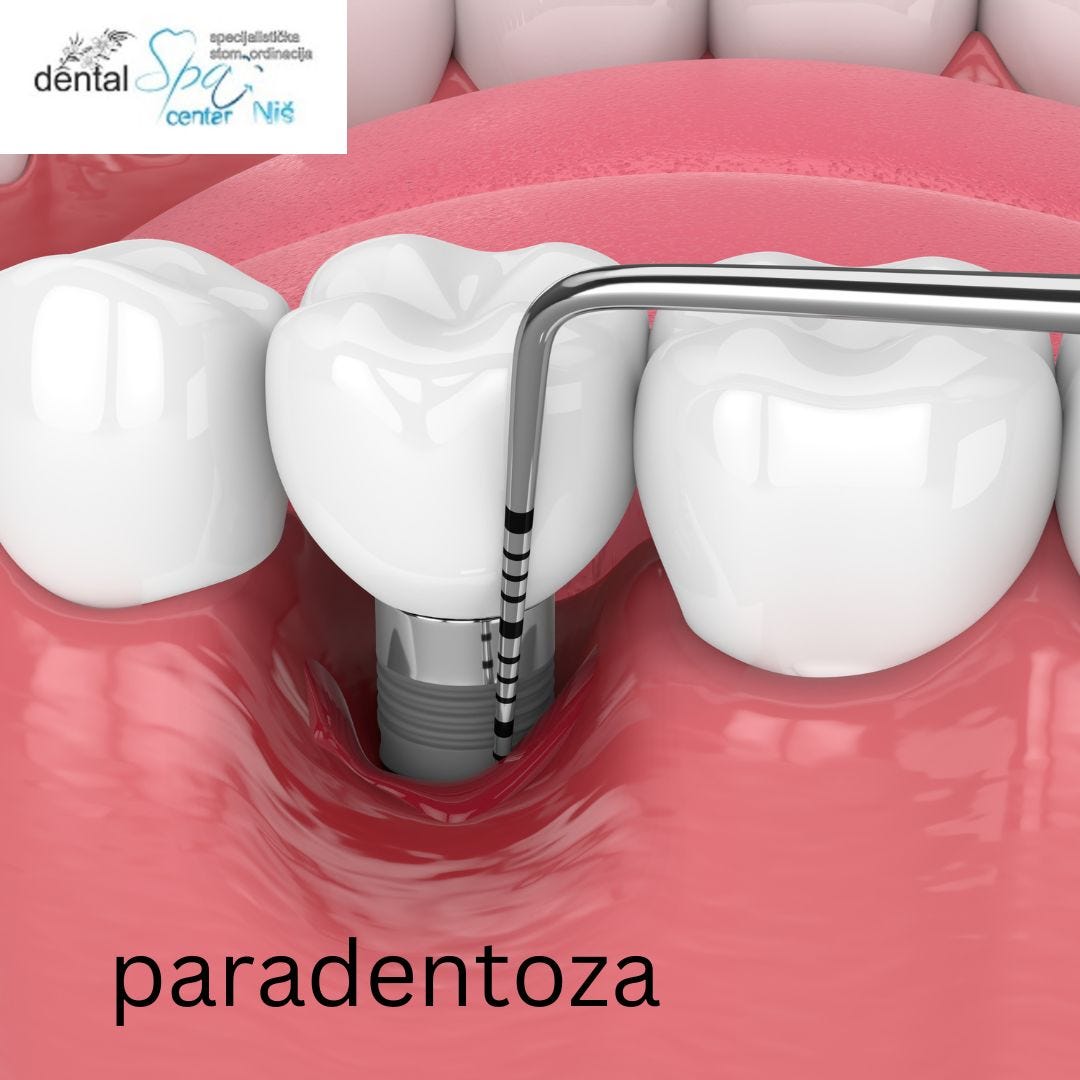 Borba protiv paradentoza: efikasni tretmani za bolesti desni - Dental ...