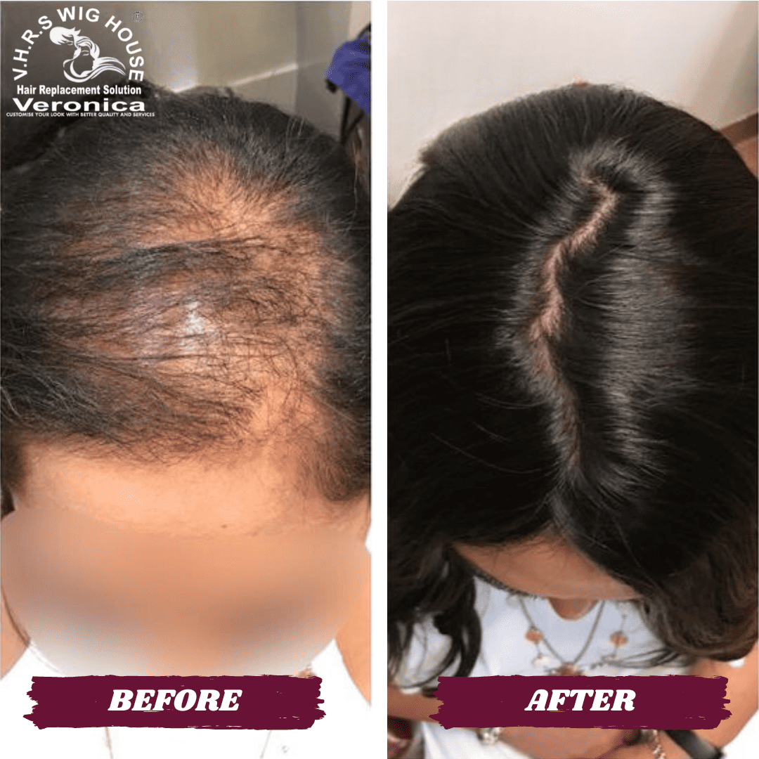 Non-Surgical hair wigs fixing in Rajouri Gardan | Best Hair Patch ...