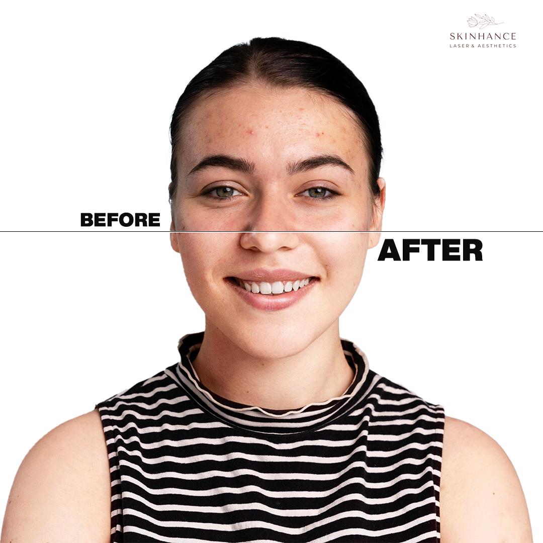 Unlocking Clear Skin Comprehensive Acne Treatment Solutions At