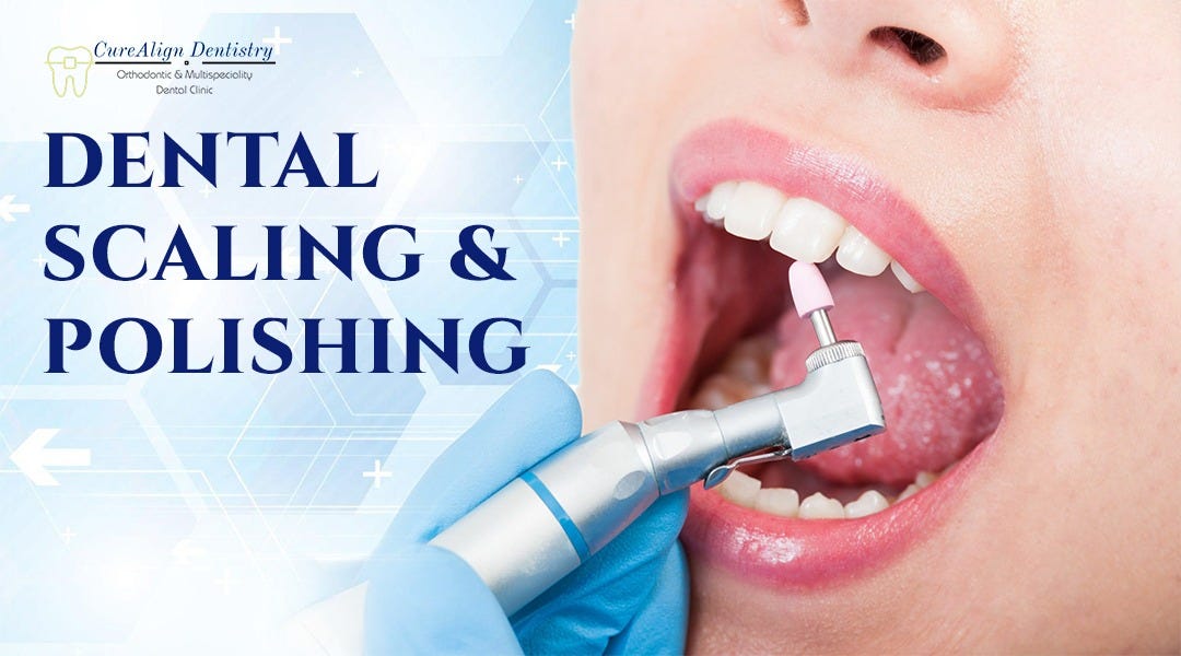 Dental Scaling and Polishing in Hennur, Bangalore — CureAlign Dentistry ...