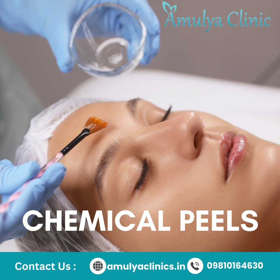 Revitalize Your Skin with Chemical Peels | Best Cosmetic Surgery Delhi ...