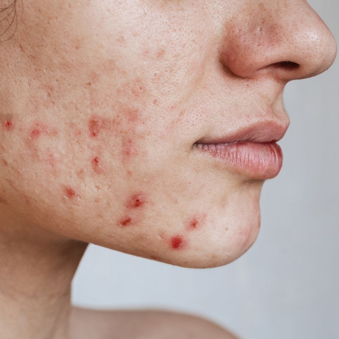 Ultimate Scar Removal Guide: Expert Tips for Flawless Skin | by Top ...