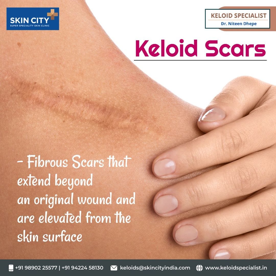 Keloid Scars that extend beyond an original wound and elevated from the ...