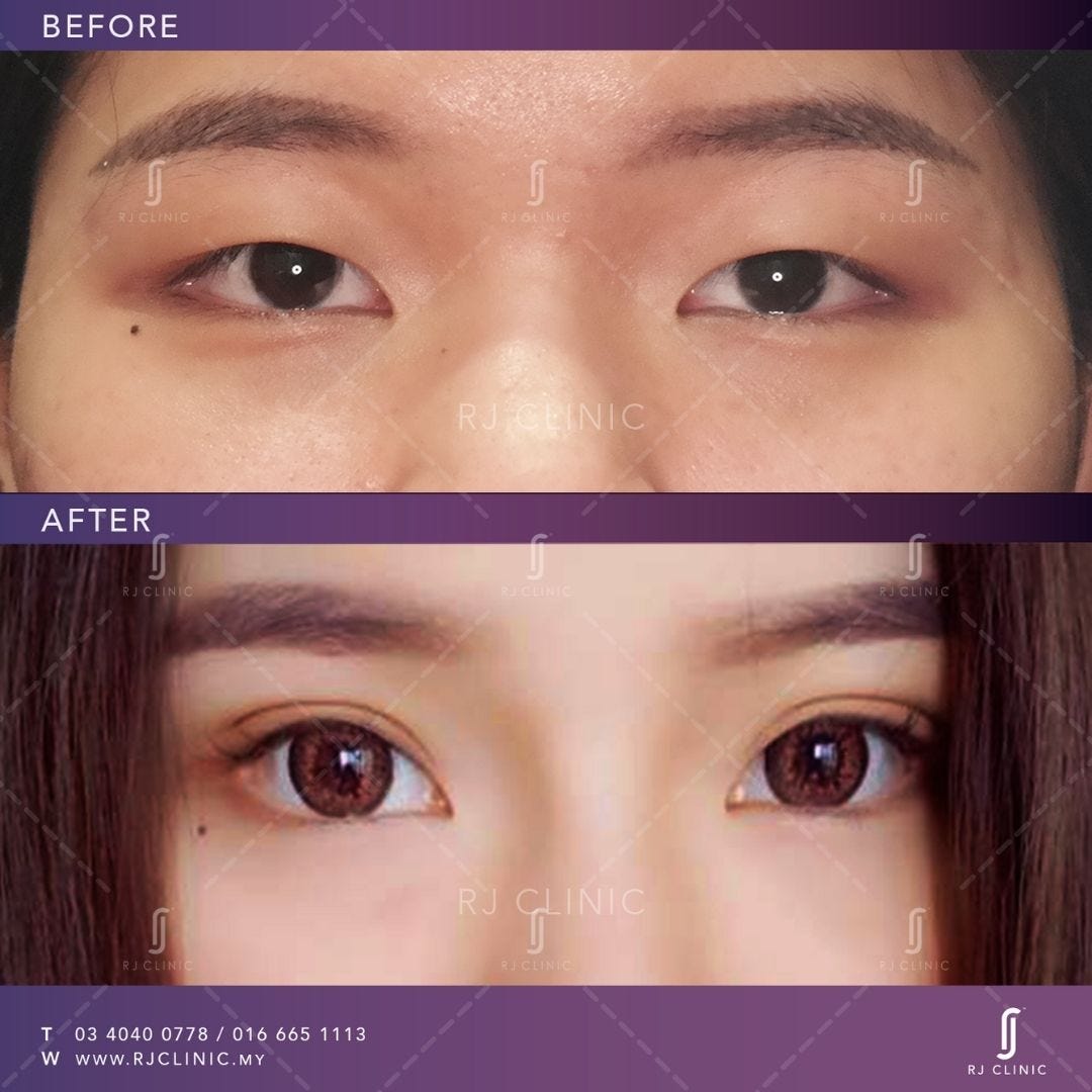 Eyelid Stitching VS Eyelid Surgery | Dr Renee (RJ CLINIC) | Medium