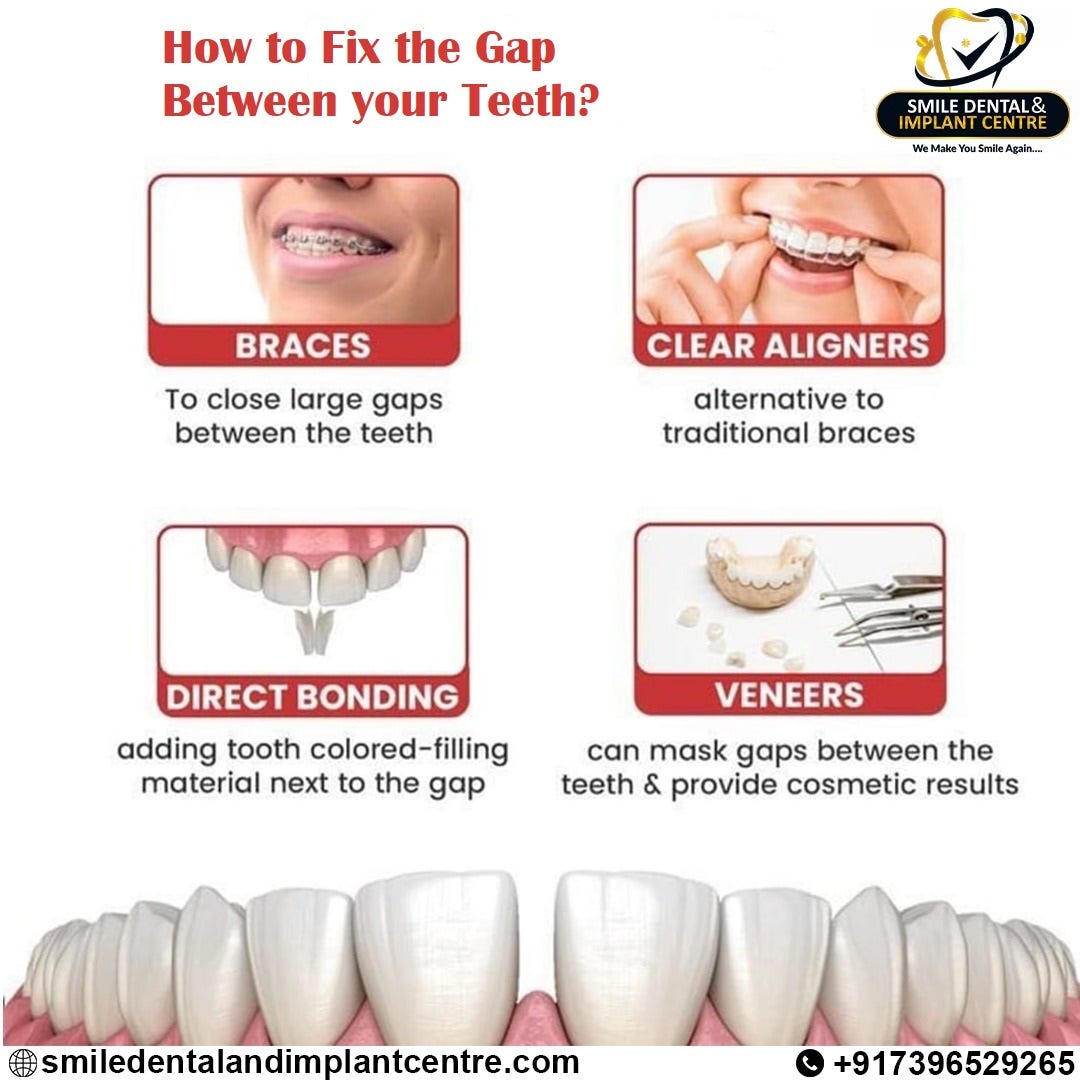 Best Treatments for Closing the Gaps in Your Teeth | Dr Puli Sudhakar ...