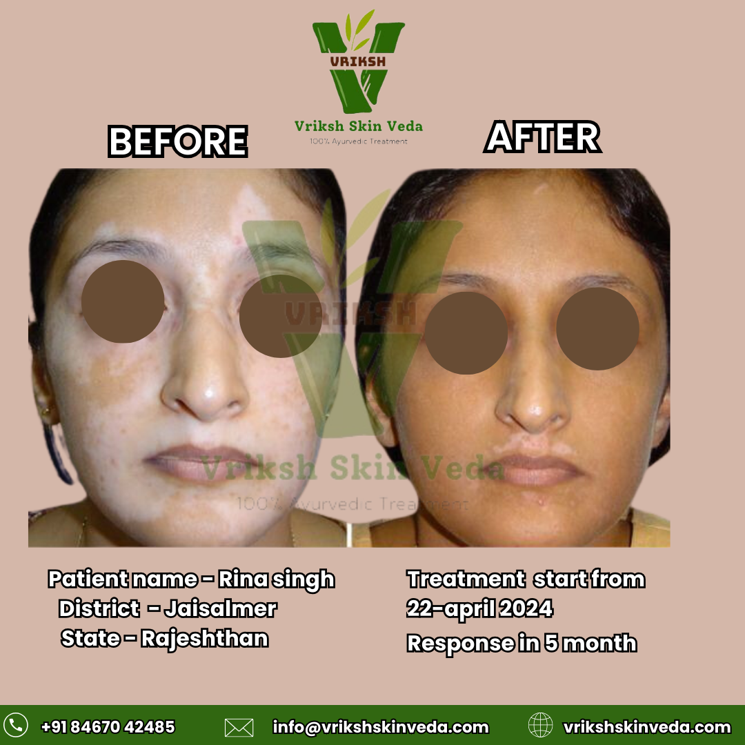 Vitiligo Treatment in Ayurveda. At Vriksh Skin Veda, a 10-year-old ...
