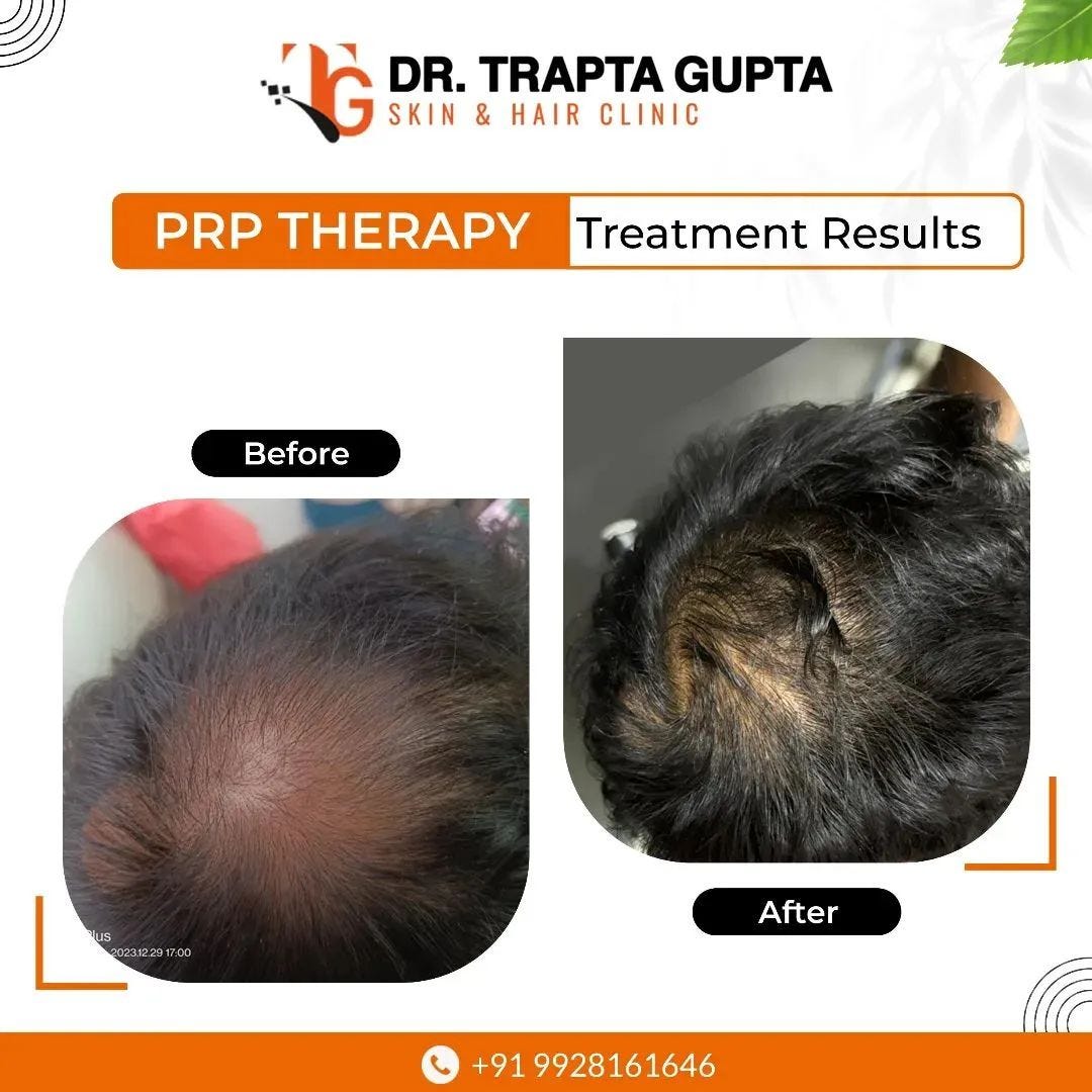 Discover the Best PRP Treatment Doctors in Bhiwadi at Dr Trapta Gupta ...
