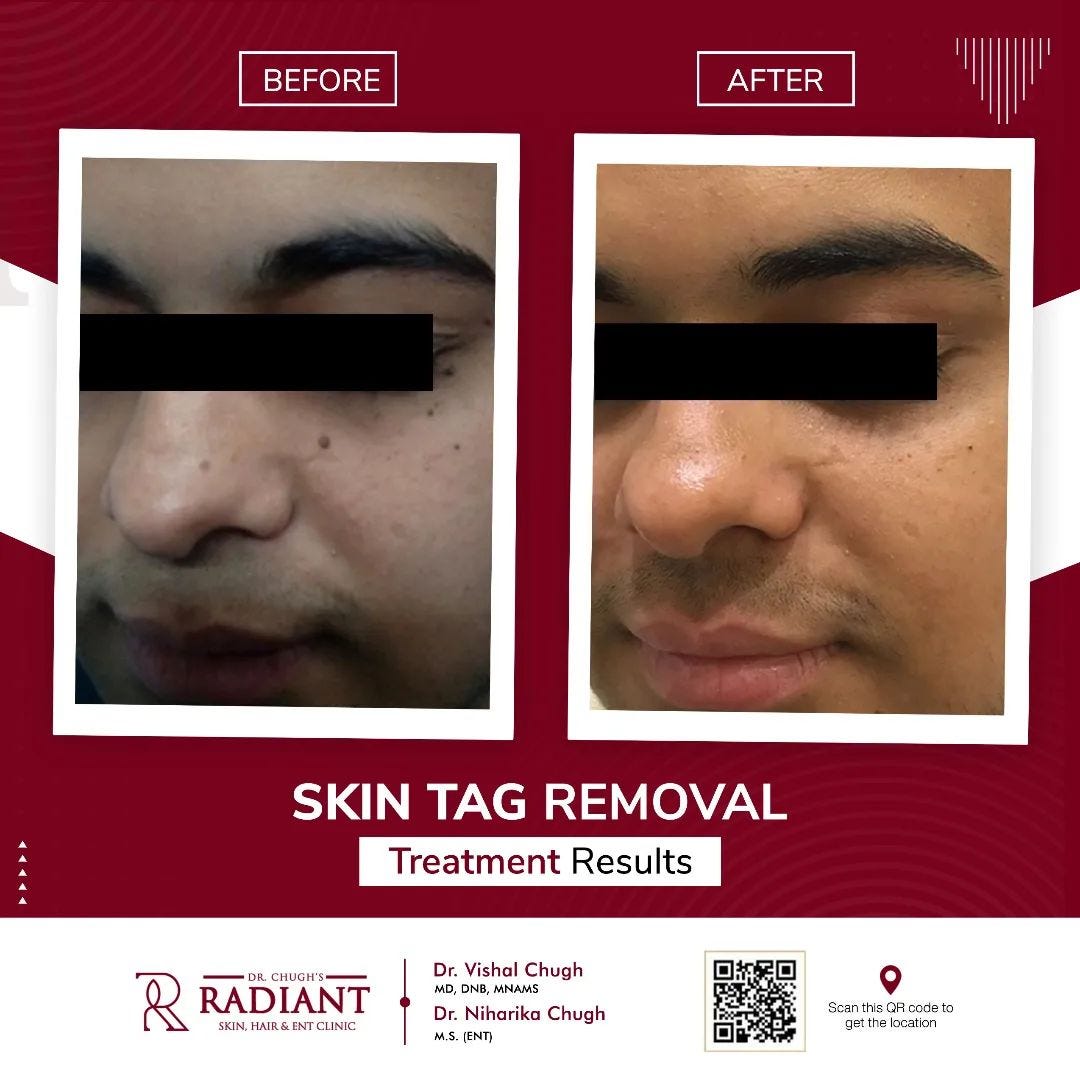 Effective Skin Tags Treatment in Jaipur | by Radiant Skin Clinic | Jun ...
