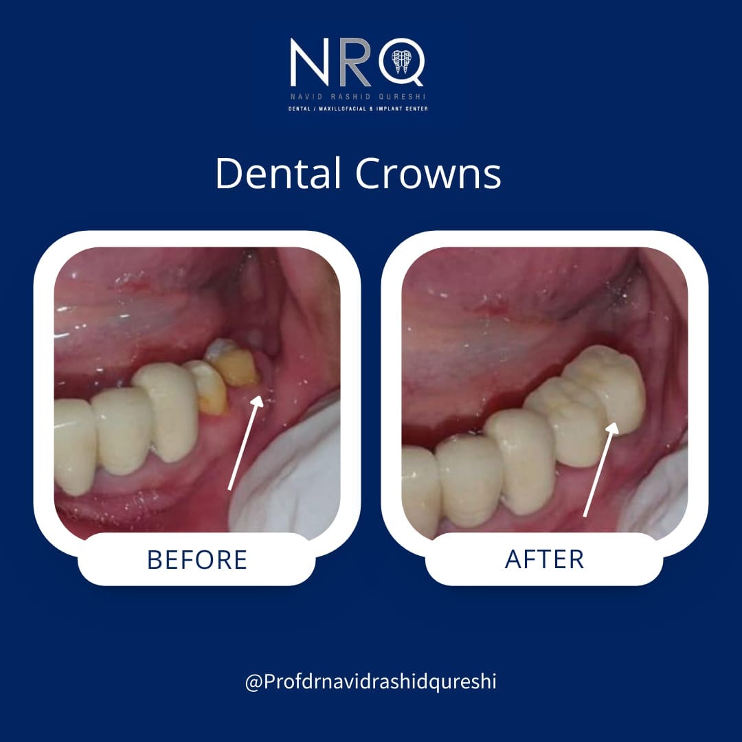 Dental Crowns - Drprofnavidqureshi - Medium