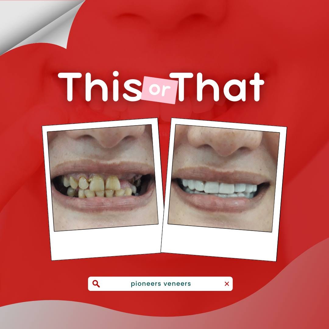 Best Snap on Veneers. Snap-on veneers have become… | by Marcia Gordon ...