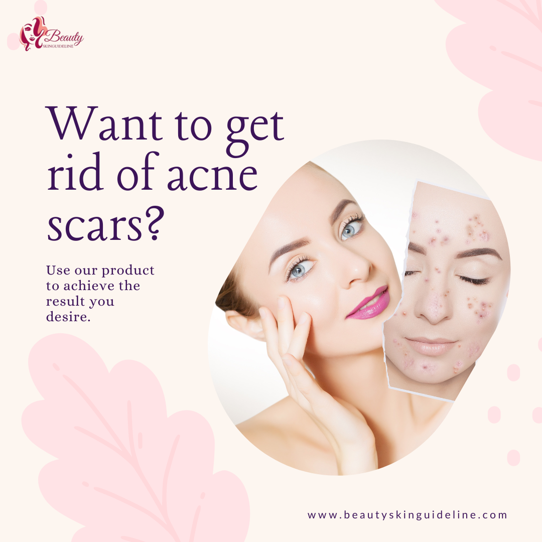 Want to Get Rid of Acne Scars? Here’s What You Need to Know | by Beauty ...