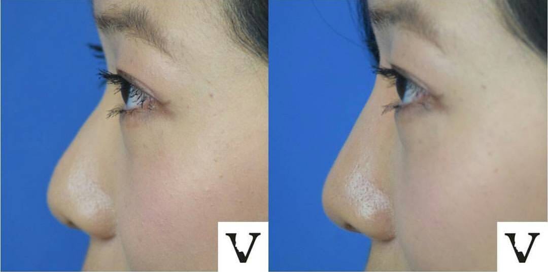 SURGICAL OFF WAY OF ASIAN NOSE JOB BOSTON | by Visage Sculpture | Medium