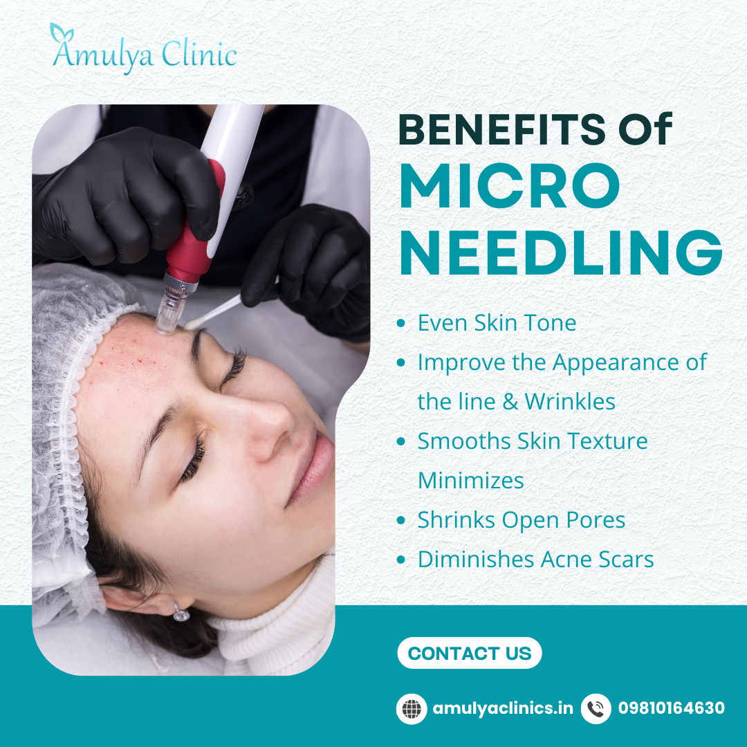 Discover the Benefits of Micro-Needling for Radiant Skin | Best ...