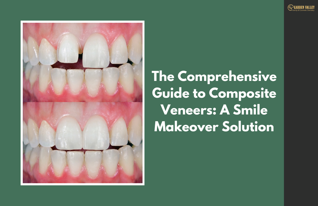 The Comprehensive Guide to Composite Veneers: A Smile Makeover Solution ...