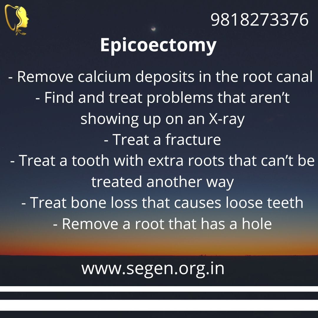 What is Apicoectomy?. An apicoectomy is a common dental… | by ...