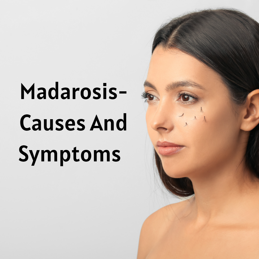 Madarosis — Causes and symptoms. Madarosis is a condition in which you ...