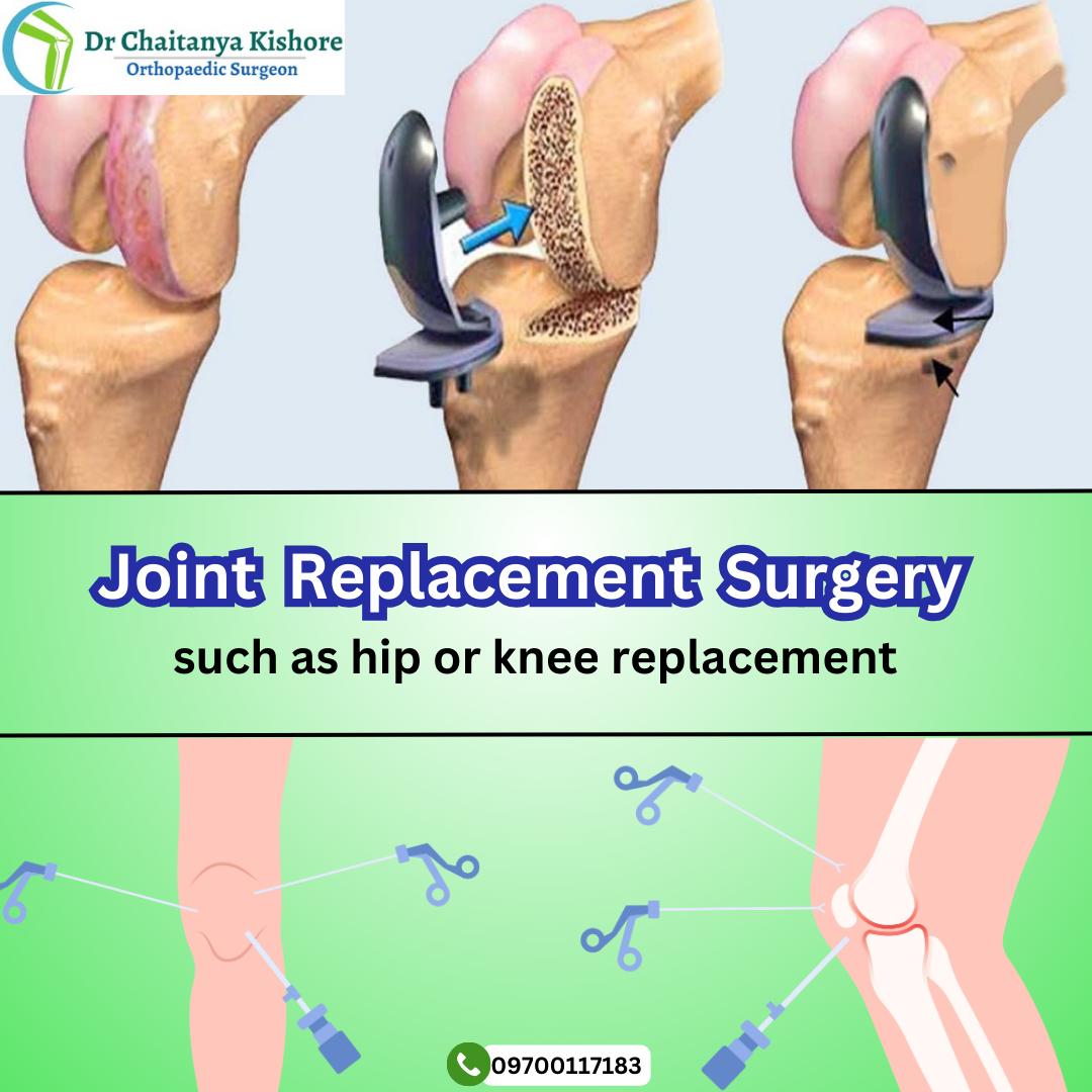 Joint replacement surgery - Drchaitanyakishore - Medium