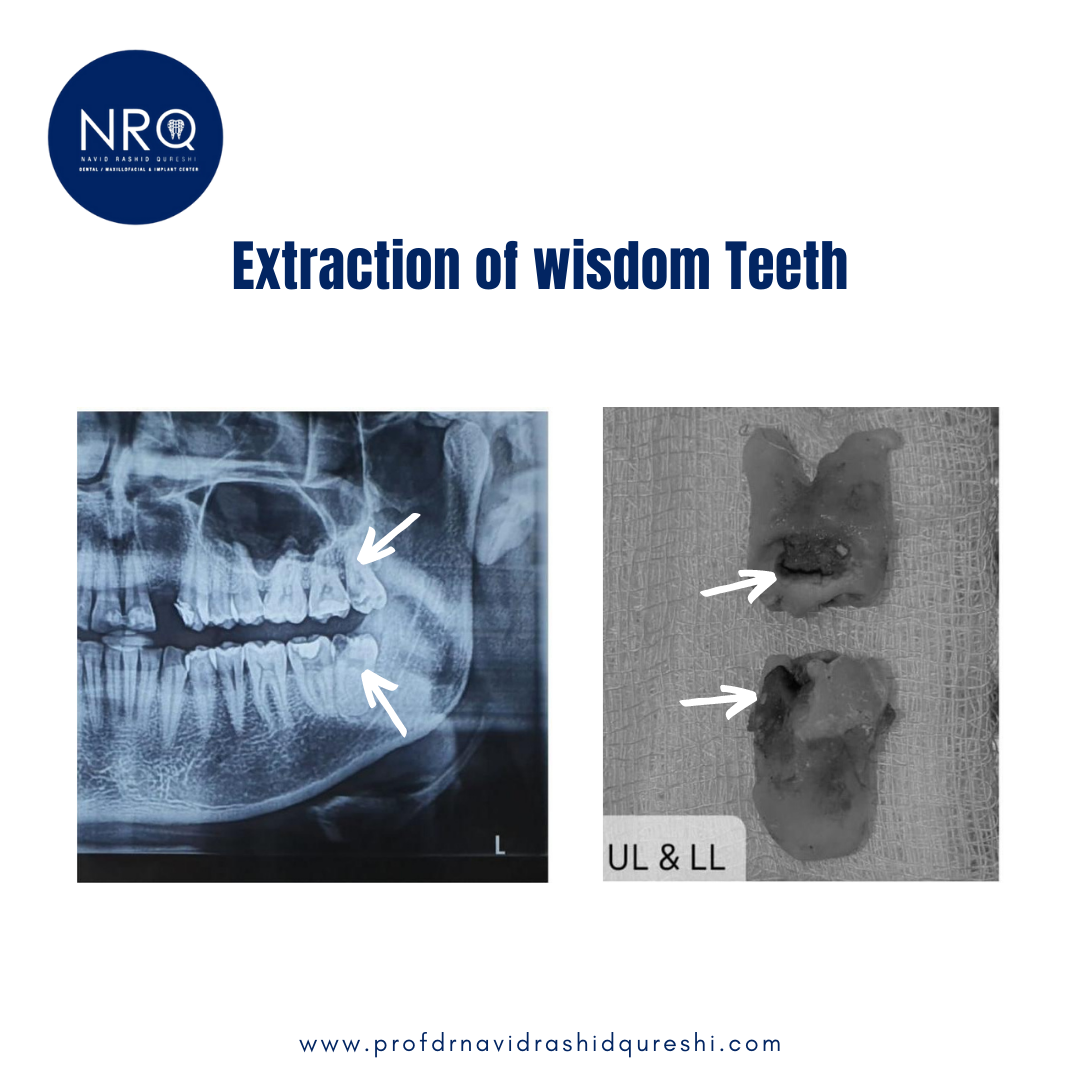 Extraction of the wisdom tooth - Drprofnavidqureshi - Medium