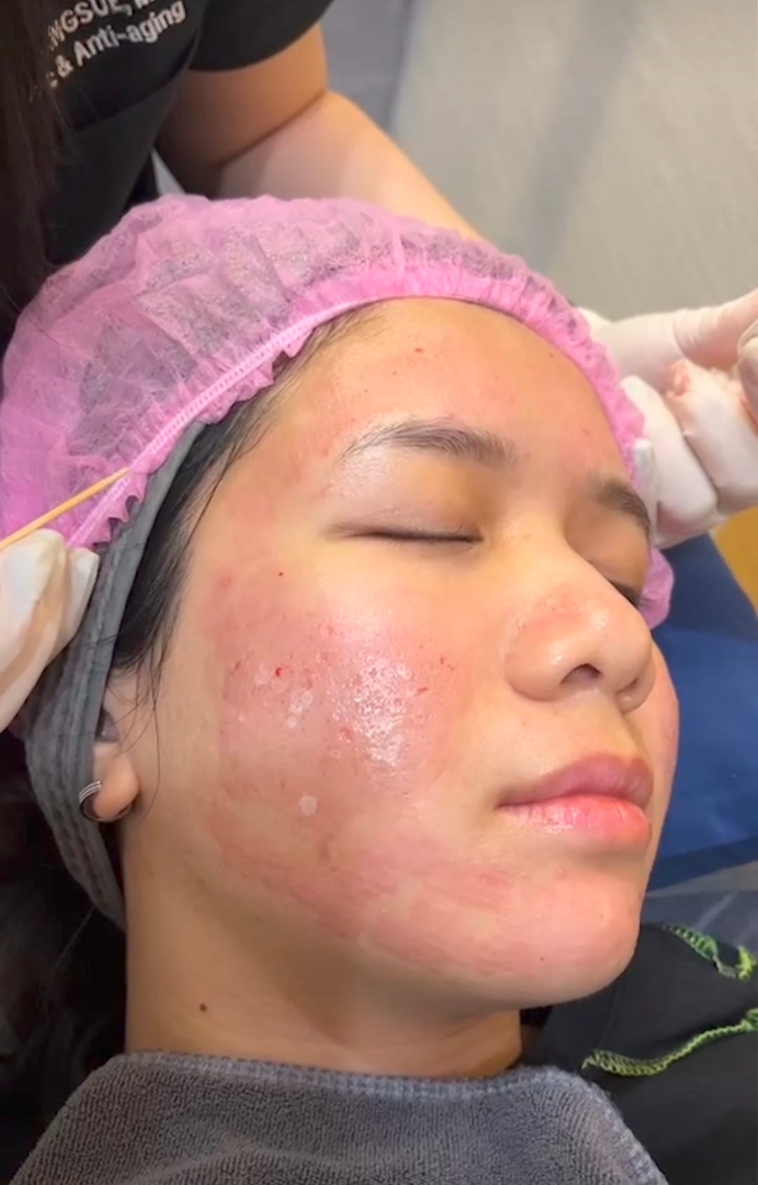 TCA Cross for Acne Scar-Bangkok Aesthetic Clinic (BAC) | by Dr ...