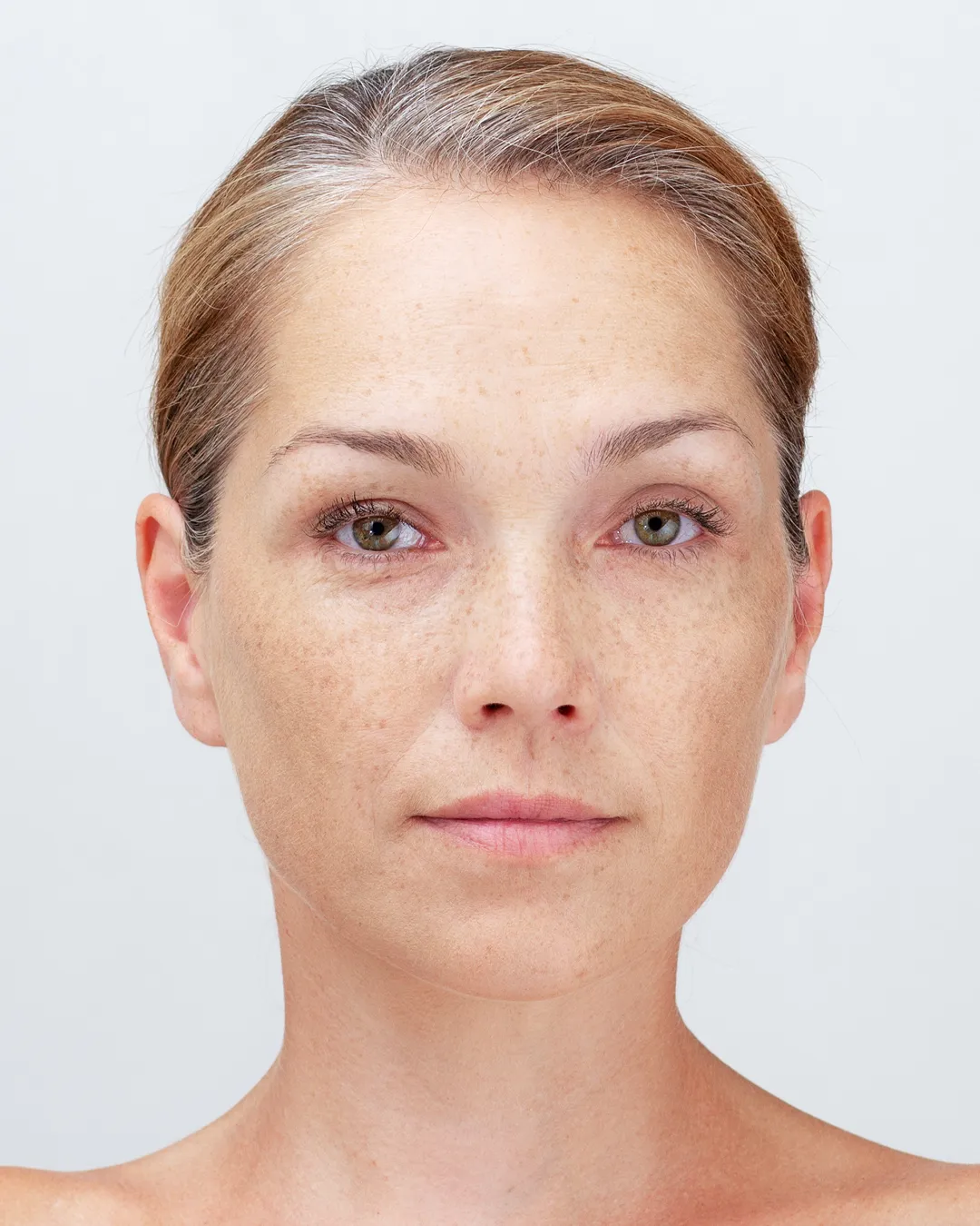 Is Pigmentation Treatment a Permanent Fix? | by Dyamic Clinic | Apr ...