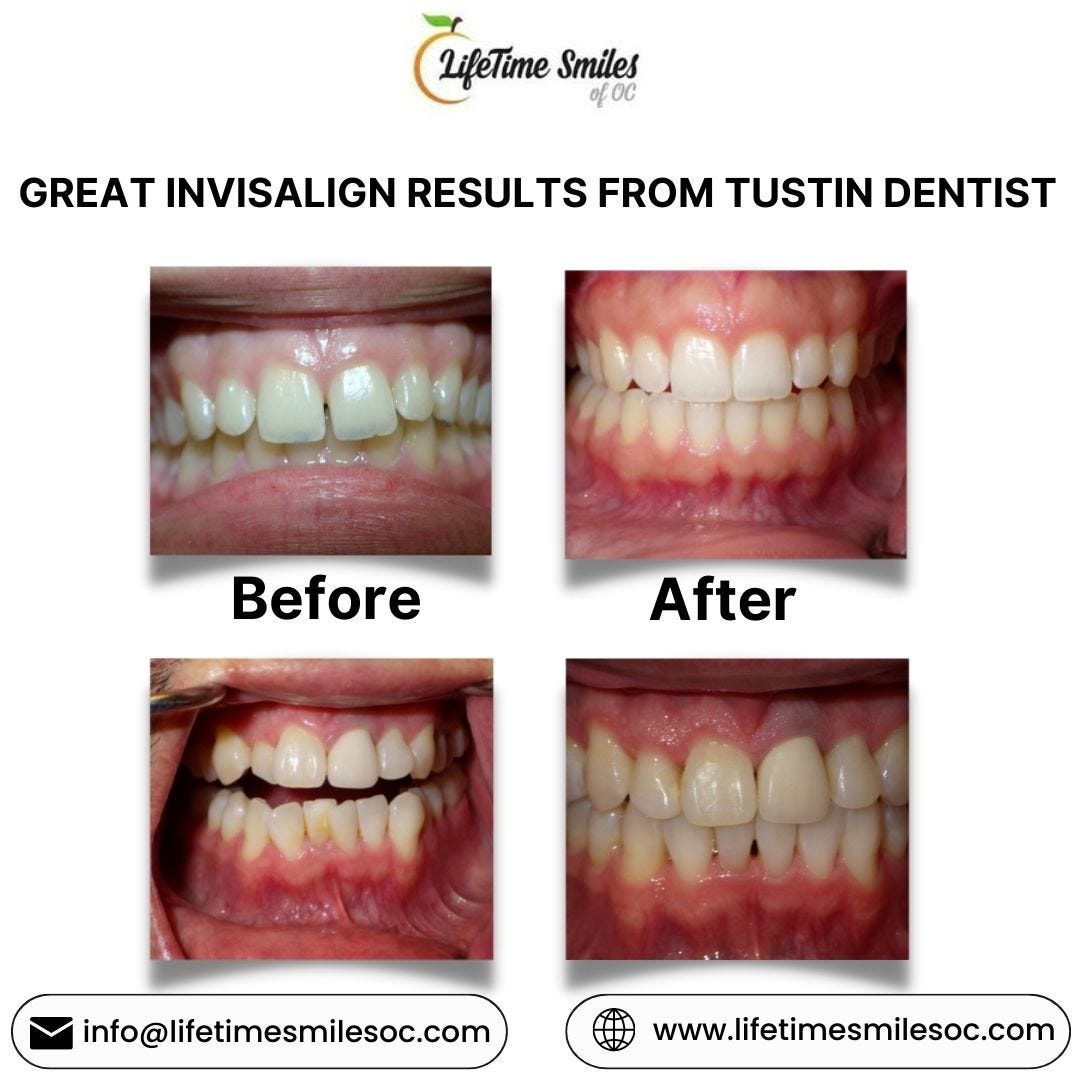 GREAT INVISALIGN RESULTS FROM TUSTIN DENTIST - Life Time Smiles OC - Medium