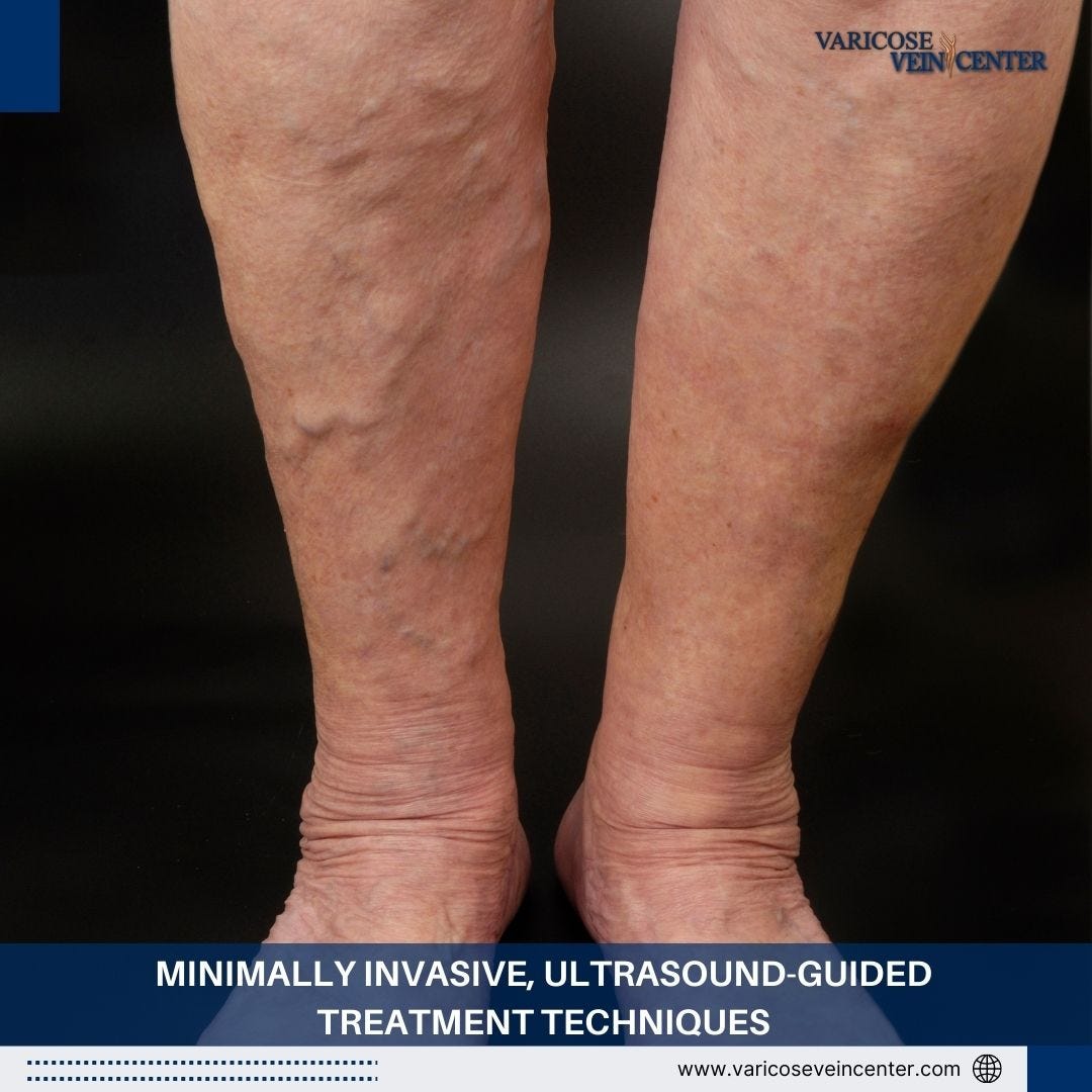 Varicose Veins Treatments Houston Vein Specialists