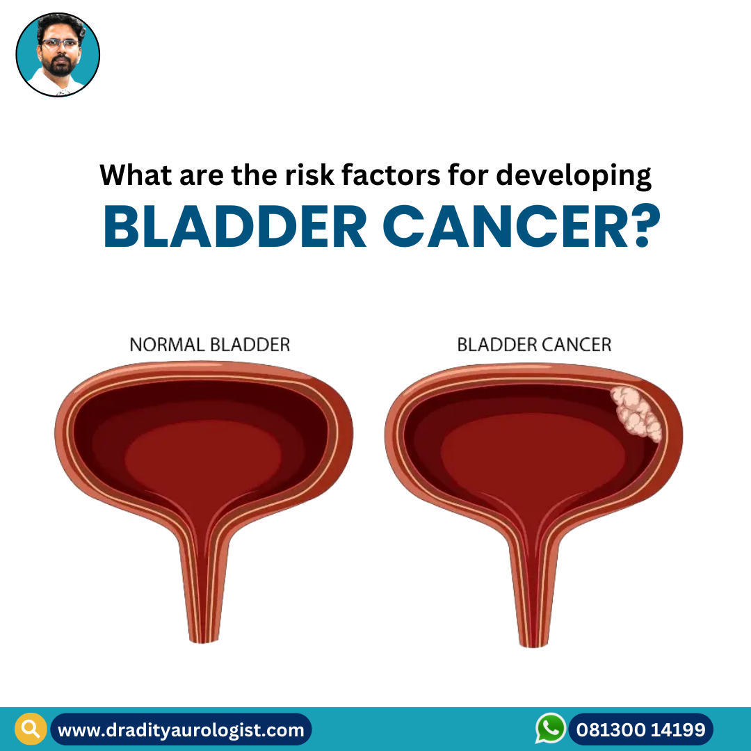 Understanding Risk Factors for Bladder Cancer | Best Urologist in ...