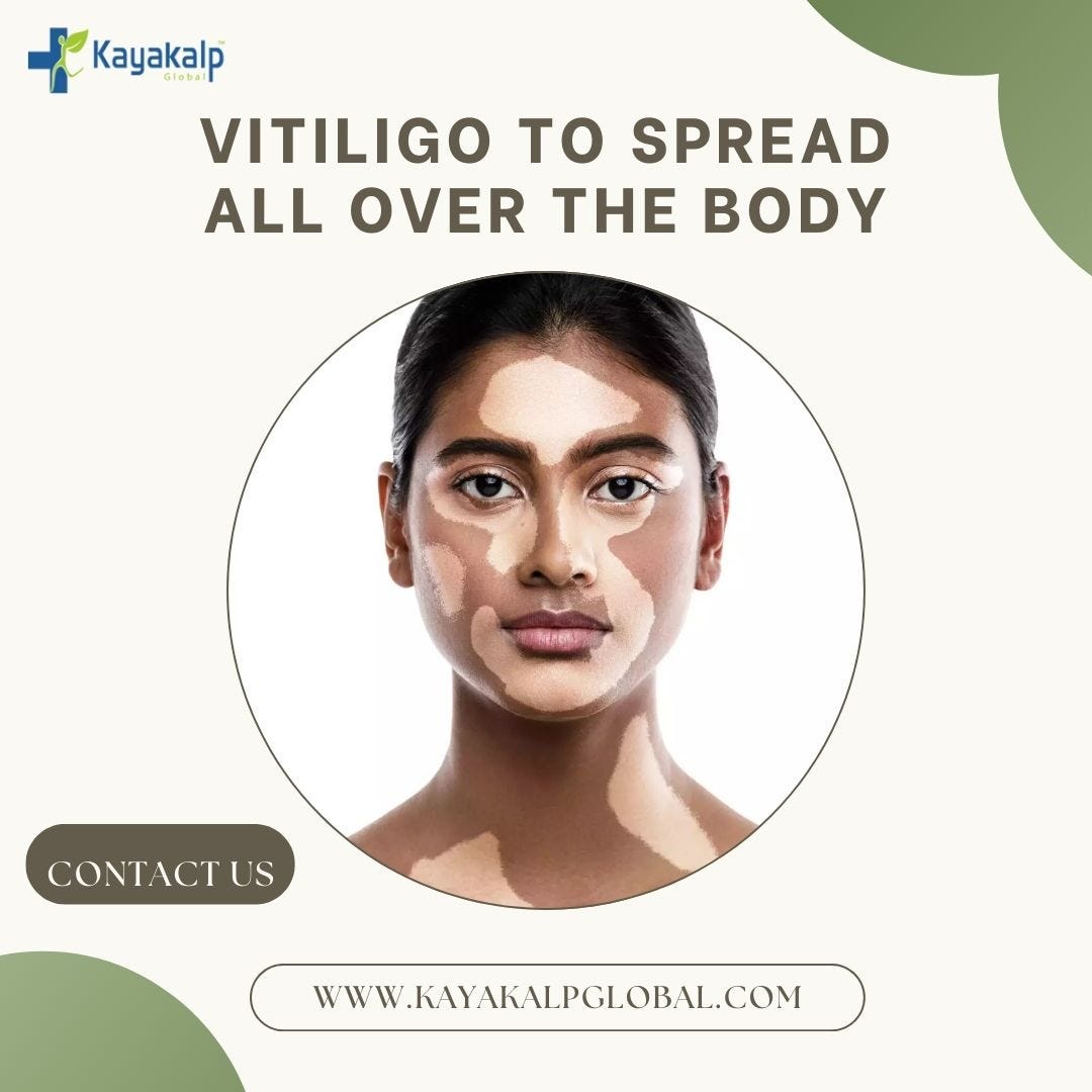 How Long Does It Take for Vitiligo to Spread All Over the Body ...