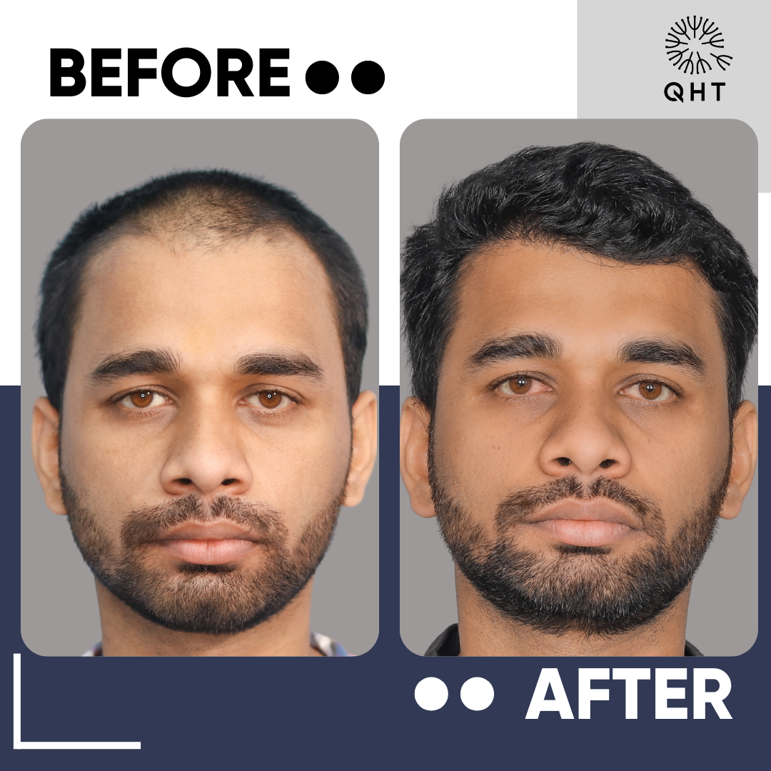 What are the most popular treatments for regrowing hair? | by COSMETIC ...