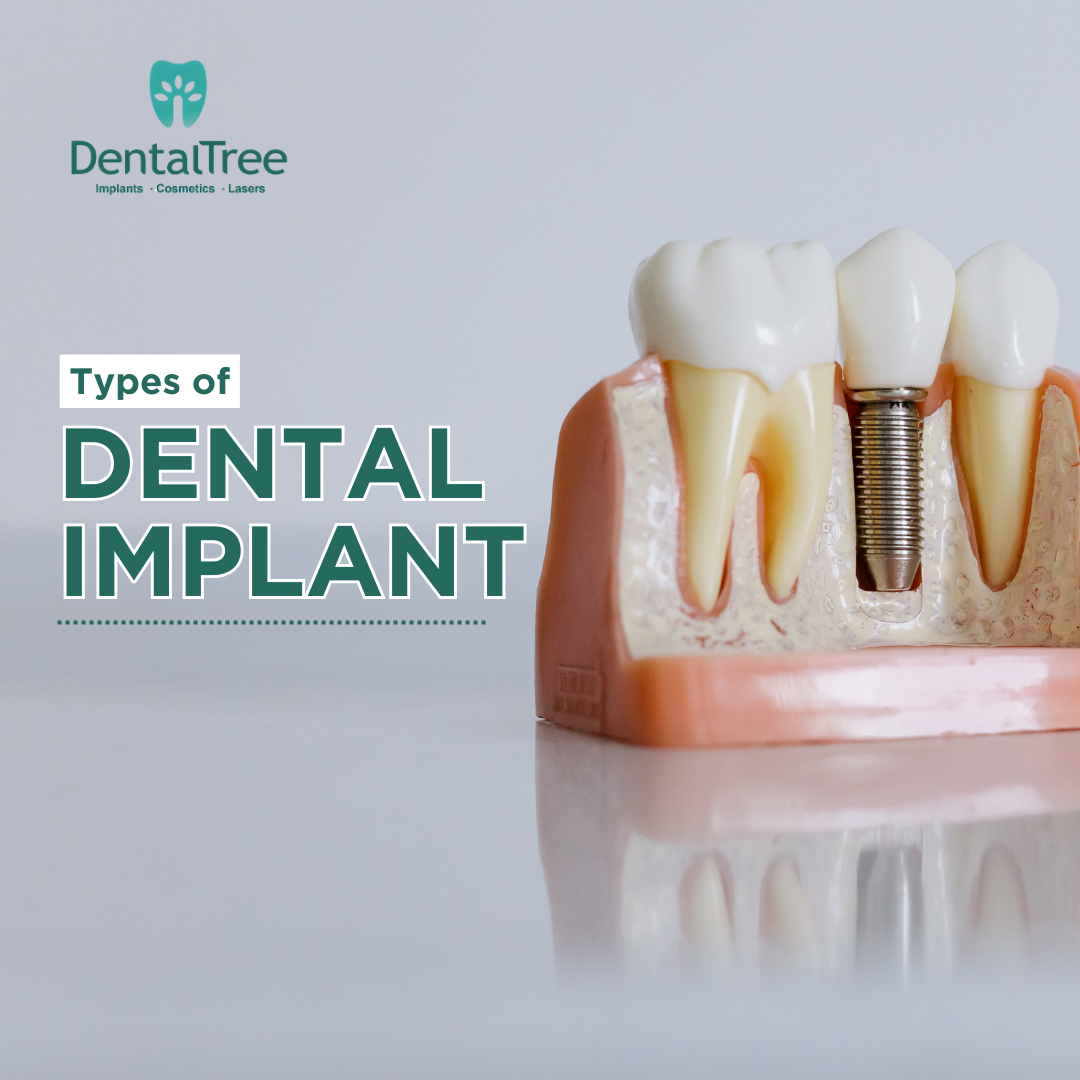 Understanding Types of Dental Implants: Your Guide | Best Dentist in ...