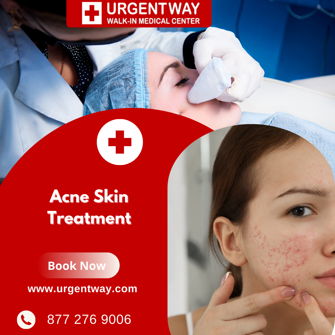 Are there any clinical trials or emerging treatments for acne that I ...