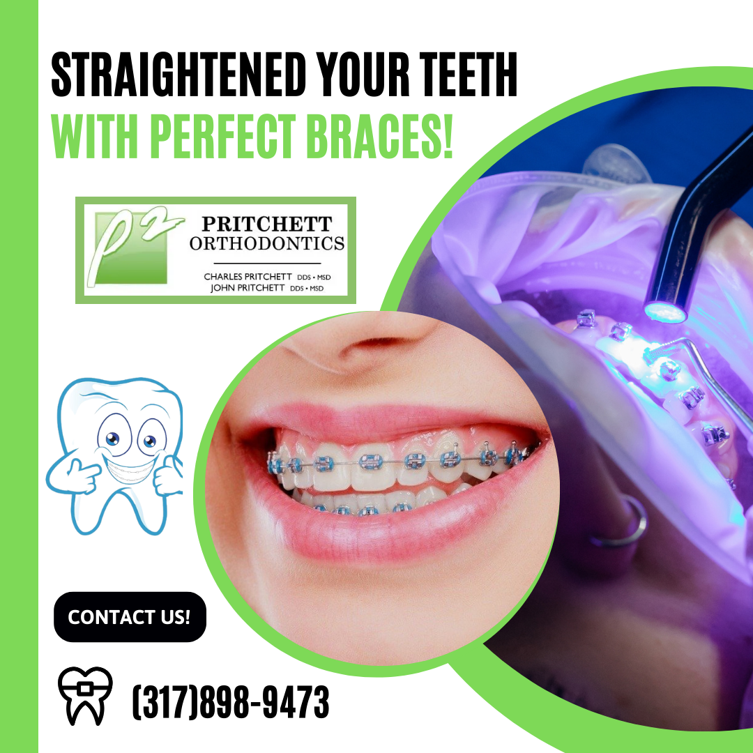 Get Most Affordable Clear Braces Here! - P2ortho - Medium