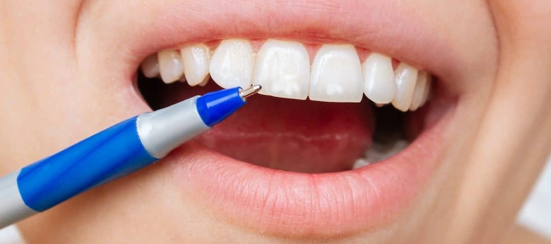 How to Remove White Spots on Teeth Naturally | by Dentology | Feb, 2024 ...