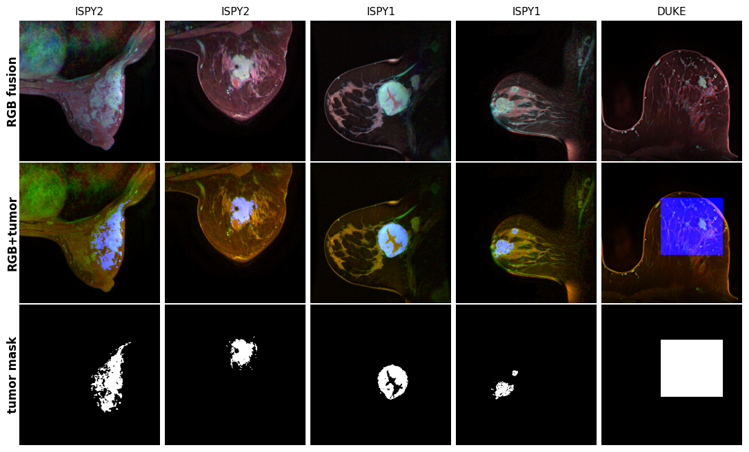 BreastDCEDL: A Dynamic Contrast-Enhanced Breast MRI Dataset | by Naomi ...