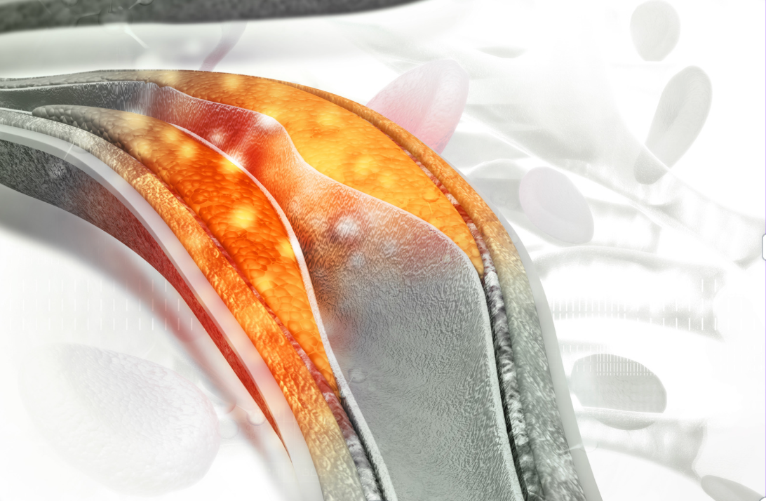 Artery Detox: How to Clean Out Your Arteries Naturally | by Canopus The ...