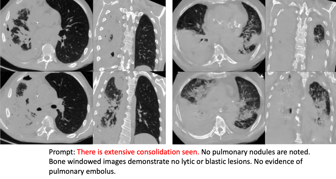 Understanding MedSyn: Another Method of Diffusion-Based Medical Image ...