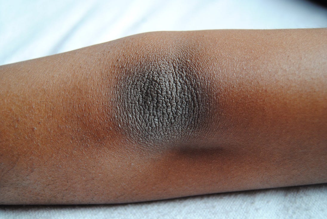 Natural Home Remedies for Dark Ankles | by healthy & stylish | Healthy ...